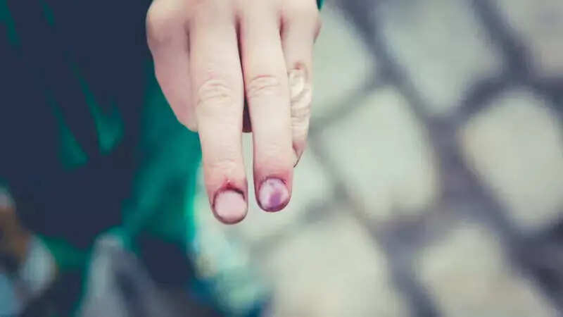5 Ways to heal bruises quickly at home