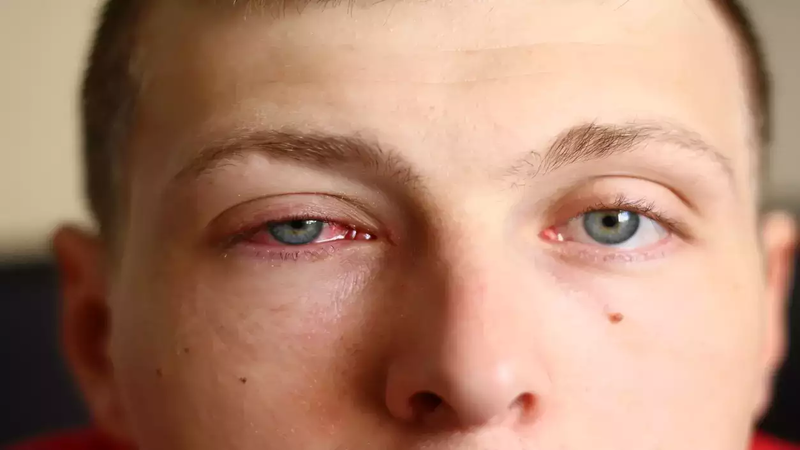 Want healthier eyes? Discover 8 ways to prevent conjunctivitis and ...