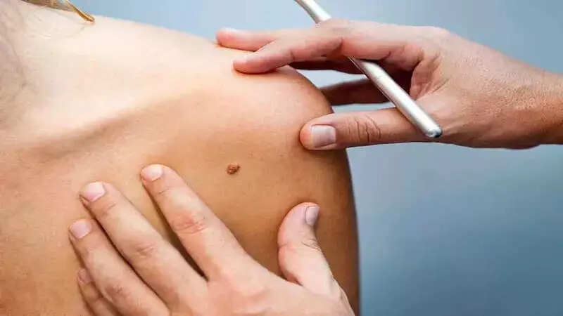 What are cancerous moles? Know about melanoma symptoms, causes and ...