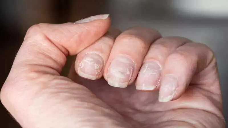 6 Reasons why you have brittle nails and how to take care of them