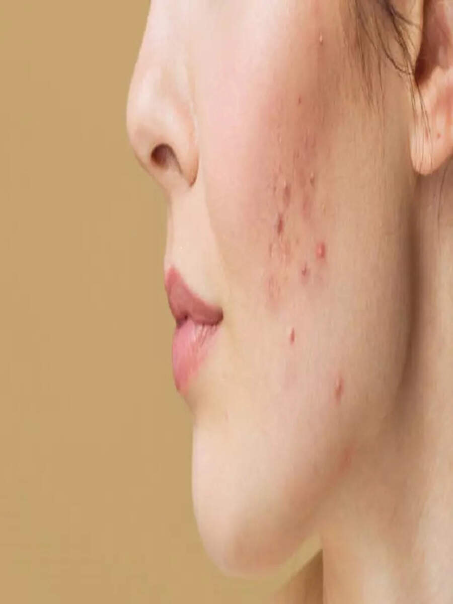 10 Natural ways to prevent acne and pimple on face | Times Now