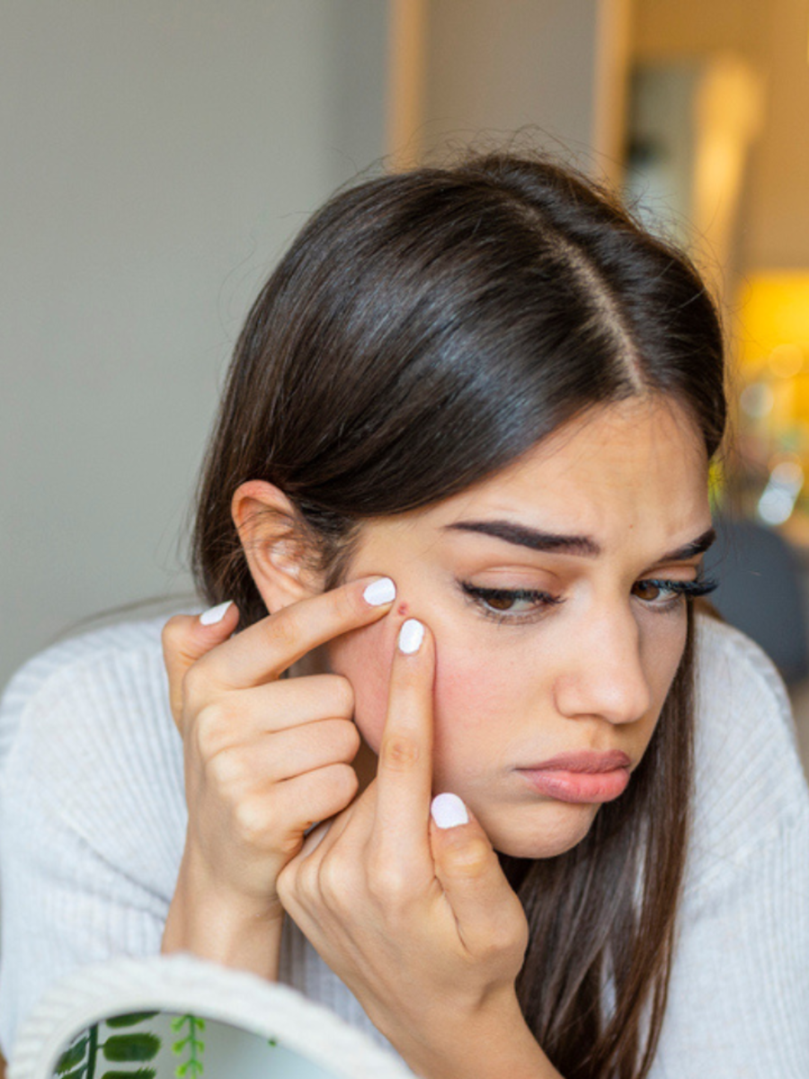 Top 10 Home Remedies for Pimples | Natural Solutions for Clear Skin ...