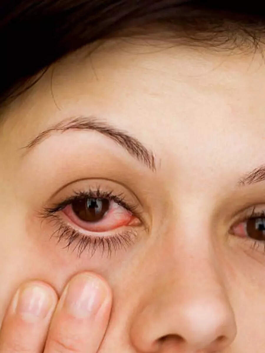 How to Prevent Eye Flu? 7 Basic Things to Keep in Mind | Times Now