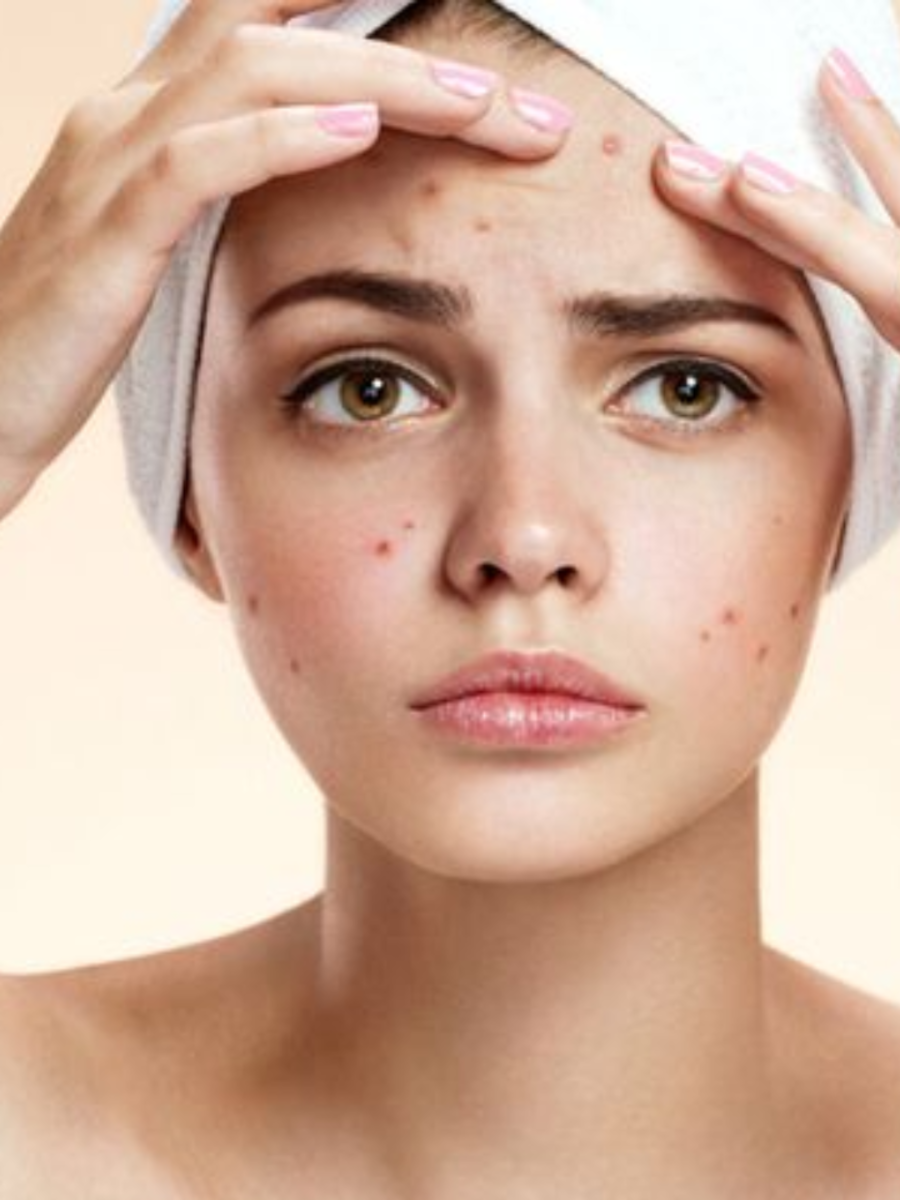 8 Ayurvedic Remedies To Get Rid Of Acne | Zoom TV
