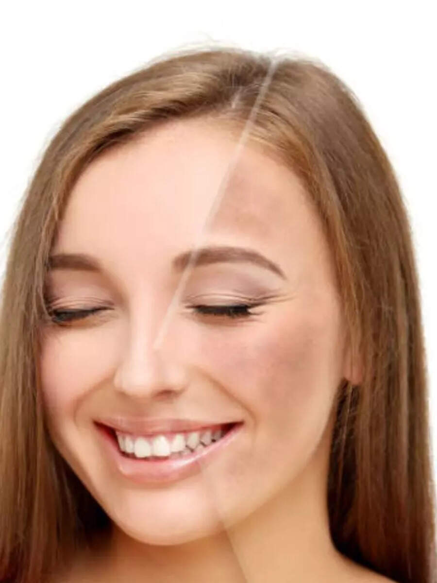 9 Home Remedies To Lighten Hyperpigmentation | Times Now