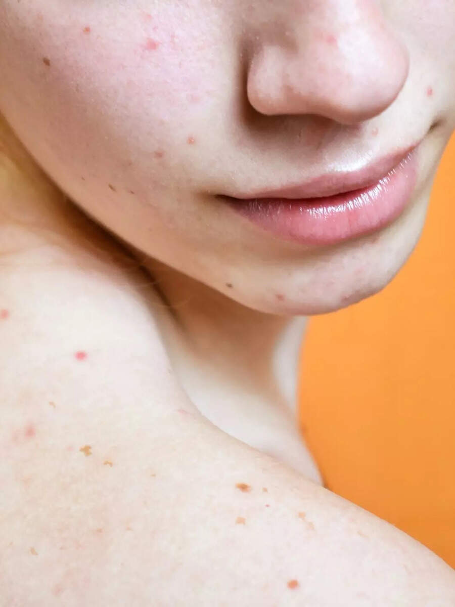 Causes and remedies for red rash on back - पाठीवर लाल पुरळ येण्याची ...