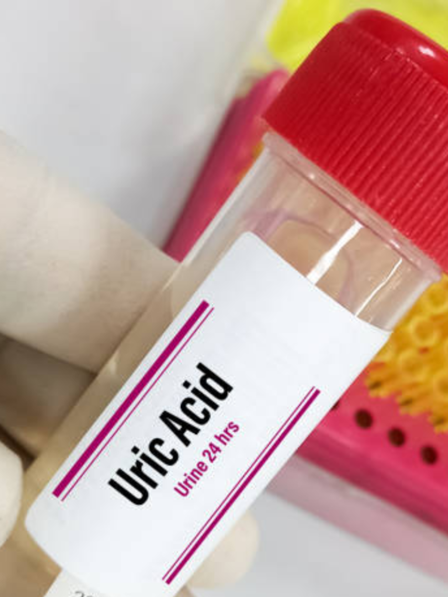 9 Foods That Help To Reduce Uric Acid Levels | Times Now