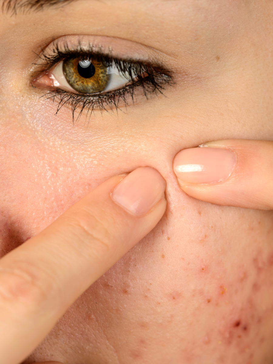 9-Step Skincare Routine for Clearer, Acne-Prone Skin | Times Now