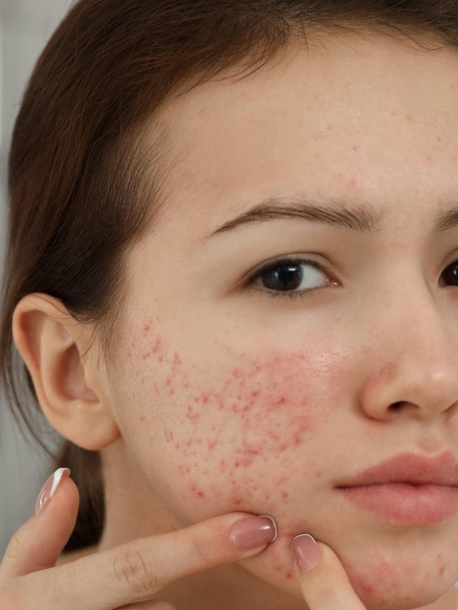 Clear Skin Guide 101: These Remedies Will Vanish Your Acne In No Time ...
