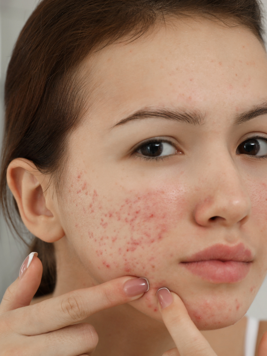 9 Ways To Treat Acne From The Root Naturally | Times Now