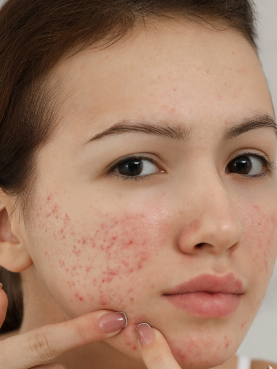 Home Remedies To Manage Acne In Winters | Health and Me