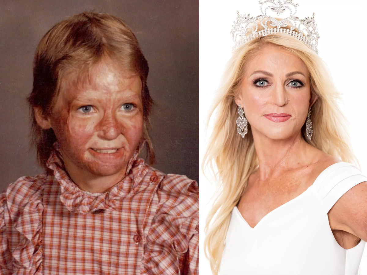 Burn survivor to beauty pageant winner Danette Burzlaff-Haag's says ...
