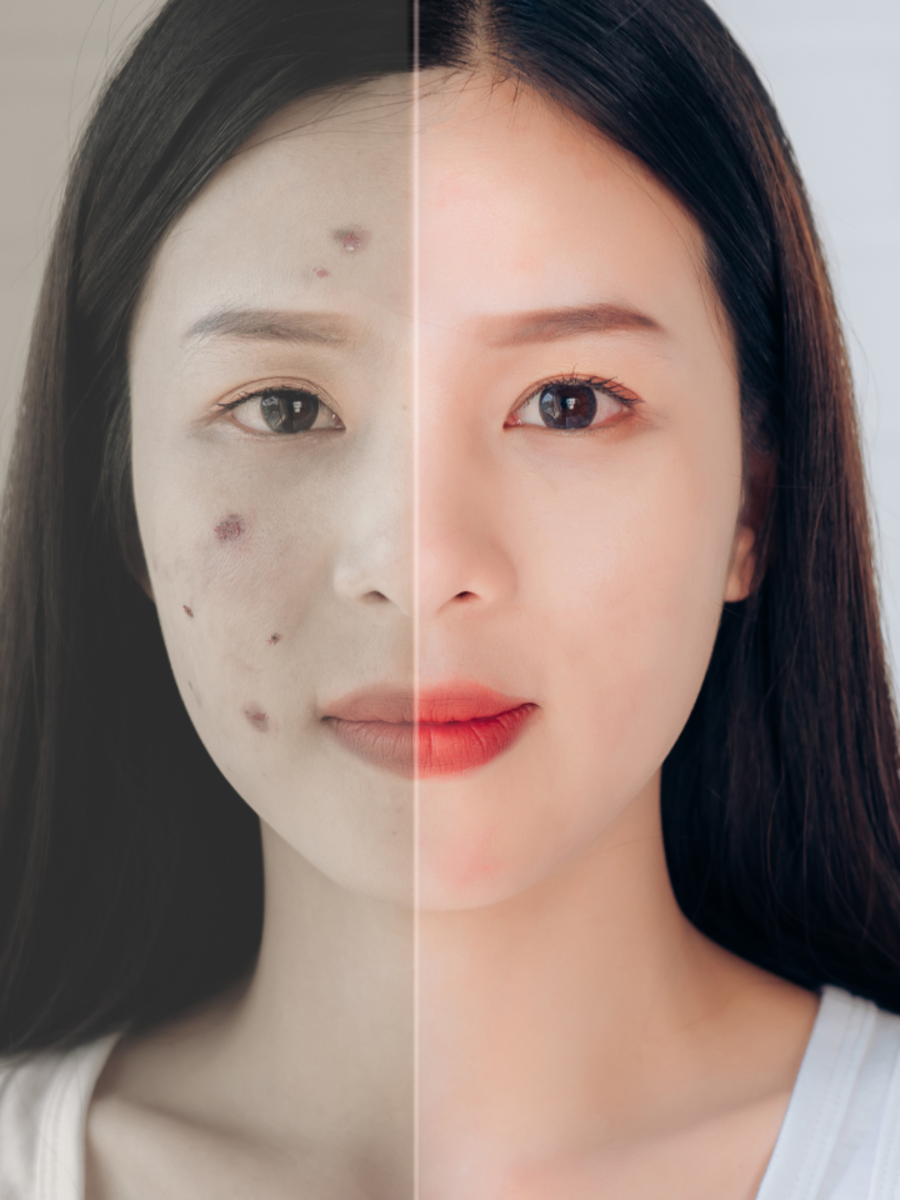 9 DIY Face Masks for Acne-Free Skin | Times Now