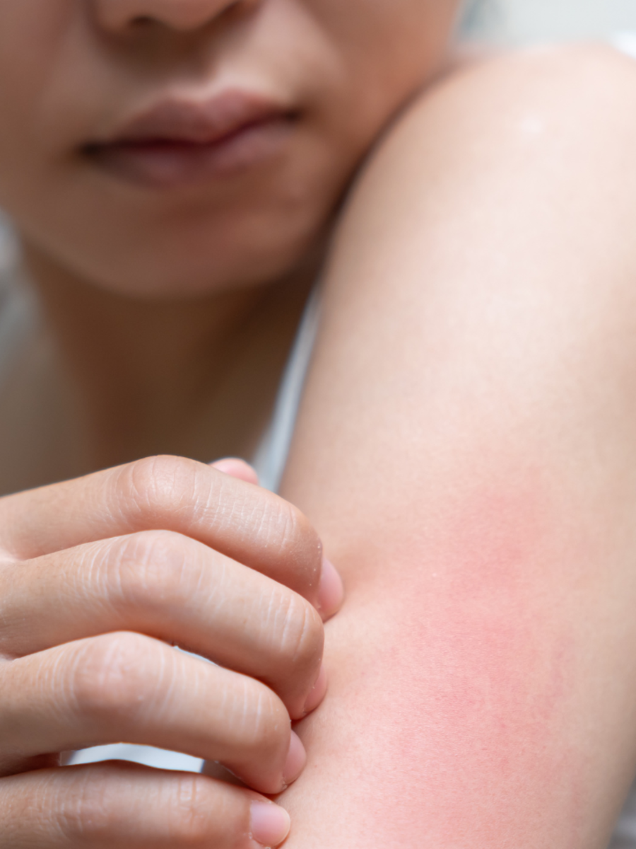Do You Have Prickly Heat Rash – Symptoms, Causes And Treatment | Health ...