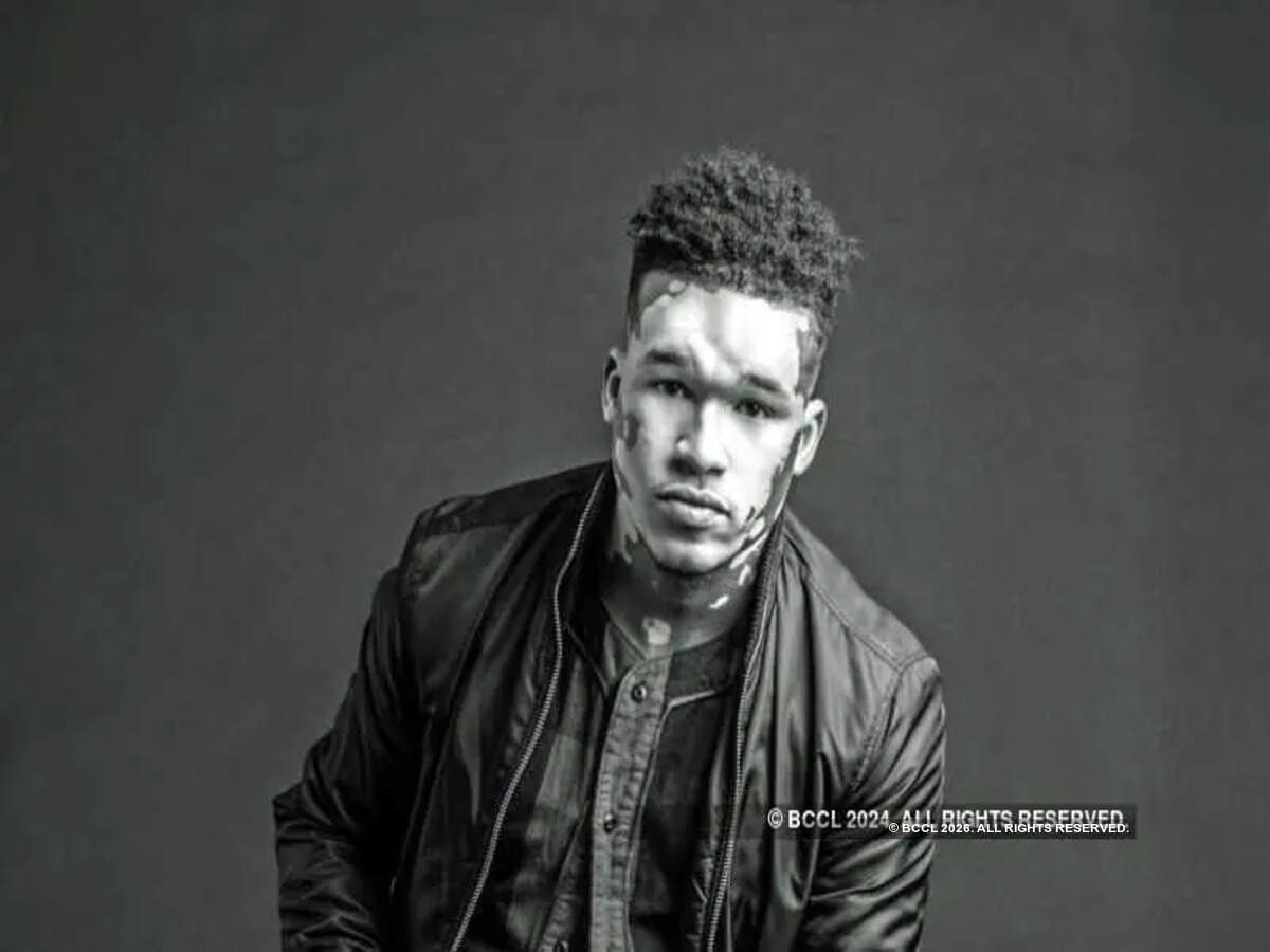 Model with vitiligo redefines what it means to be beautiful