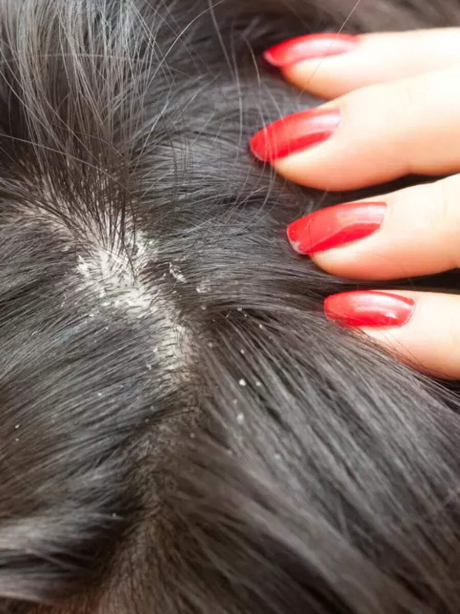 Best foods to eat to reduce dandruff naturally | Times Now