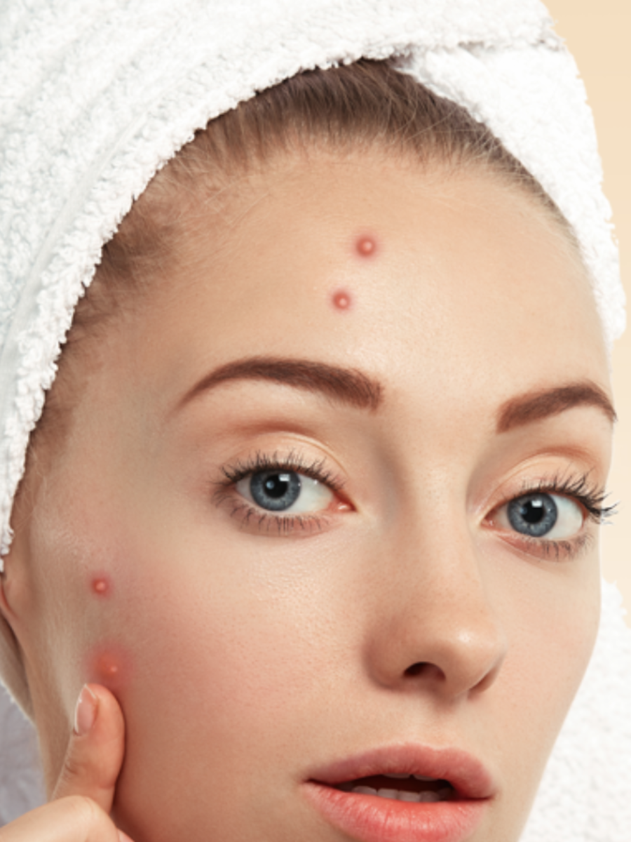 How to remove pimples on face: 9 tips for clear skin | Zoom TV