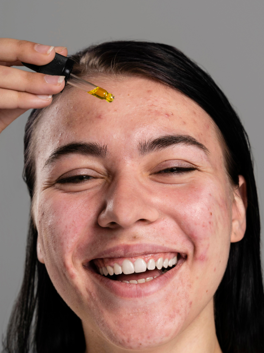 How To Use Salicylic Acid To Remove Excess Oil and Acne | Zoom TV